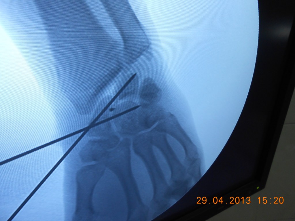 Terry Thomas sign – RP's Ortho Notes